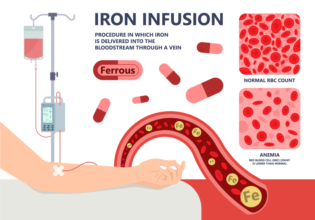 IV Iron Therapy – BMS Clinic