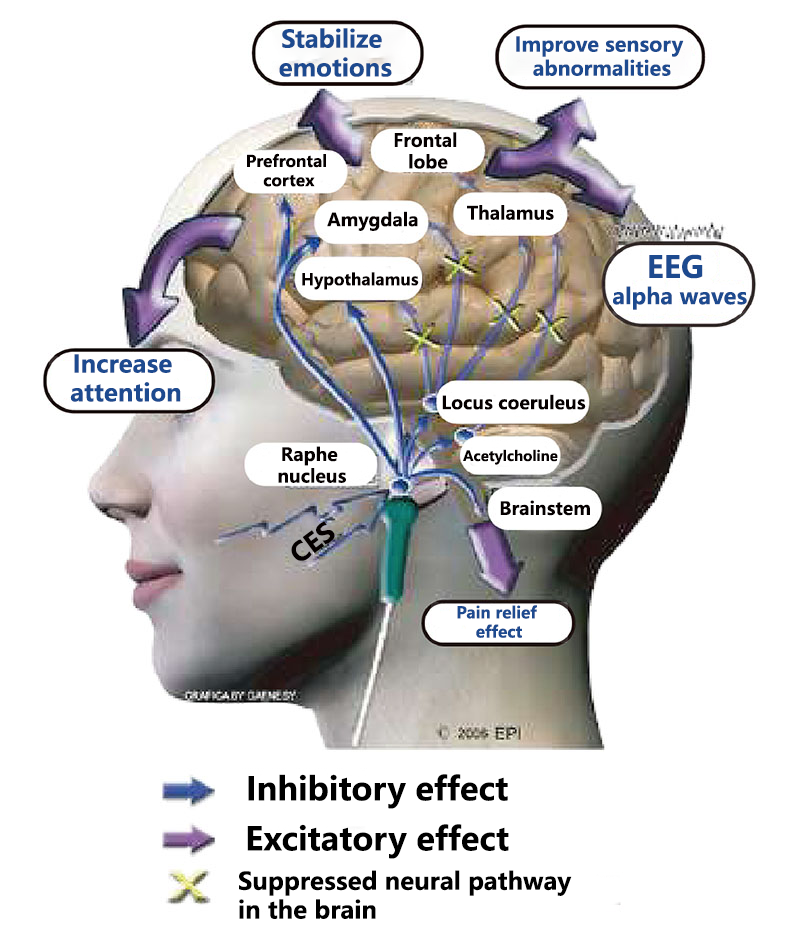Cranial Electrotherapy Stimulation – BMS Clinic